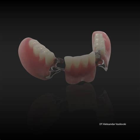 Removable Partial Denture With Bonyhard Clasps Aleksandar Vasilevski