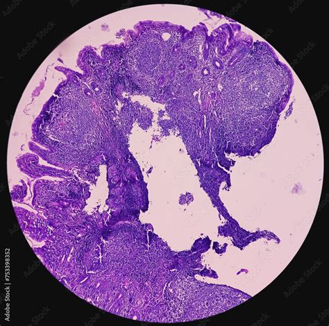 Terminal Ileum Colonoscopic Biopsy Lymphoid Hyperplasia Section