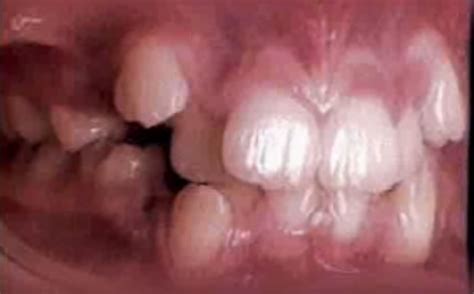 თუკი კბილების გასწორება გსურთ აუცილებლად უყურეთ ვიდეოს ვიდეო