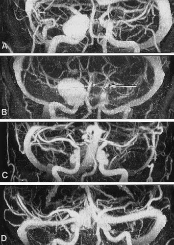 Circle Of Willis Angiogram Quiz