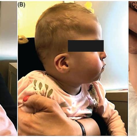 A Characteristic Dysmorphic Facial Features Including High Anterior Download Scientific