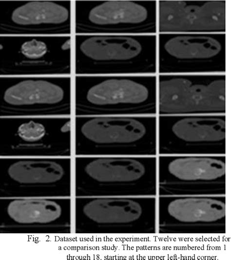 Figure 2 From 3d Image Segmentation For Lung Cancer Using U Net
