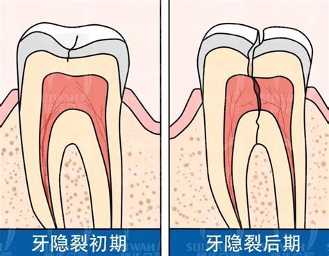 你的牙正在悄悄开裂！你注意到了吗？