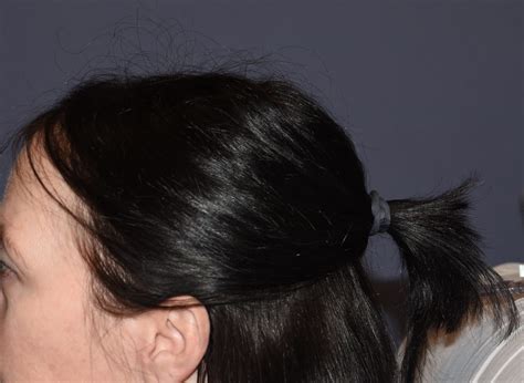 How Often Does A Scalp Tissue Expander Need To Be Filled Before Getting