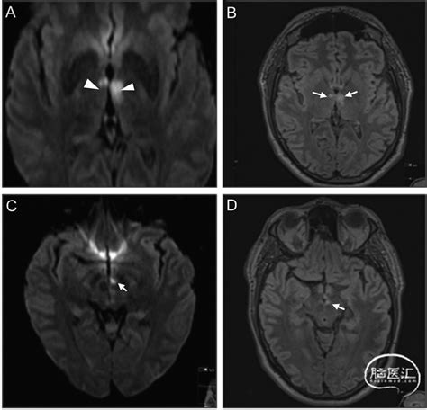 Neuroradiology：percheron动脉梗死的影像学鉴别诊断 脑医汇