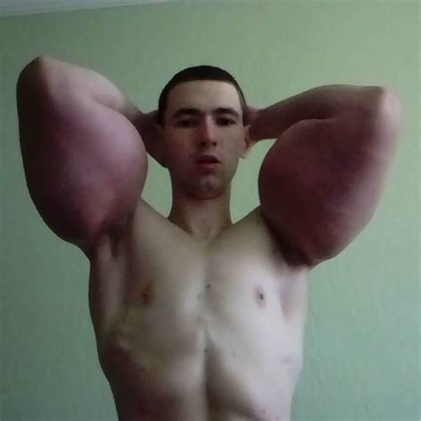 Qué Es El Synthol La Sustancia Que Se Inyectó Popeye” En El Cuerpo Y