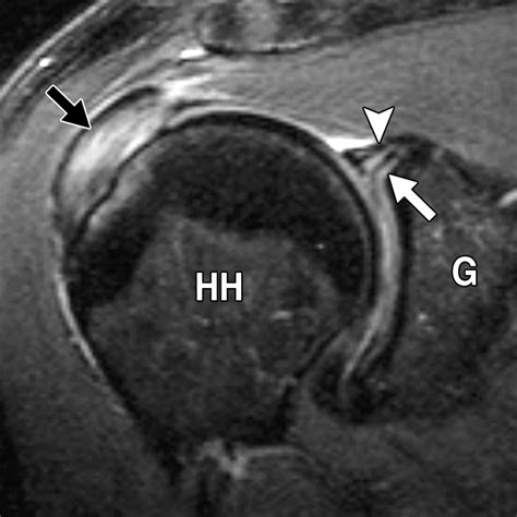 Superior Labral Anteroposterior Lesions Of The Shoulder Part 2