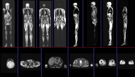 Whole Body Dwi Whole Body Dwi Planning And Protocol
