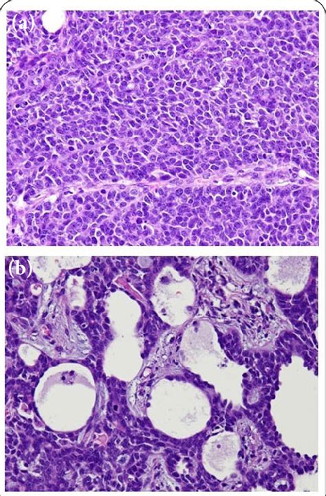 Hande Stained Biopsy Specimens Case 2 Show Neoplastic Cells In A Solid