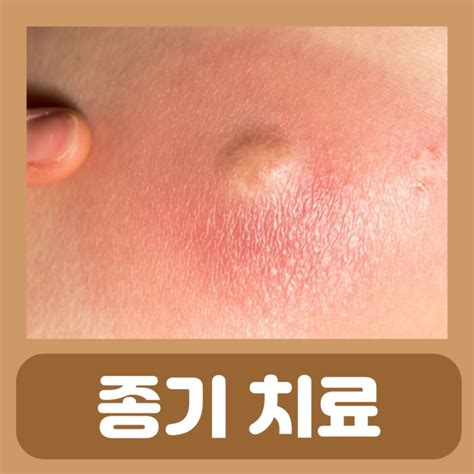 종기 치료 병원 사타구니 허벅지 엉덩이 겨드랑이 피부 종기 원인 치료 연고 약 화농성 한선염 네이버 블로그