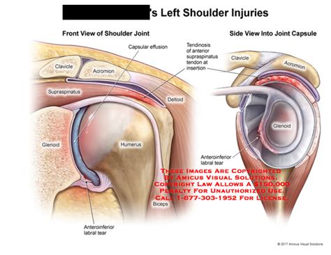 Left Shoulder Injuries