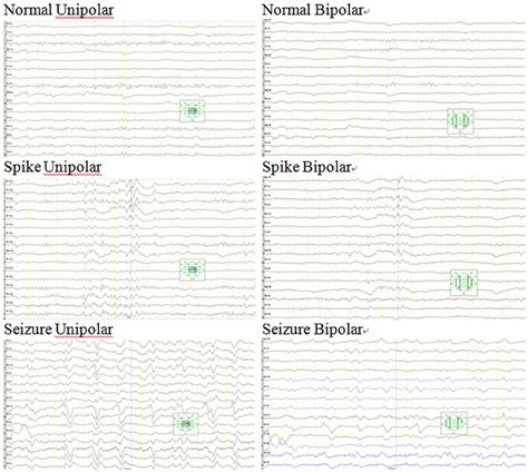 Exemplars Of Eeg From The Three Conditions Normal Spike And Seizure