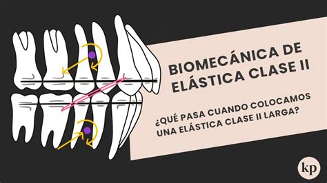 Biomecánica De Las Elásticas Clase Ii Largas Karen Prieto
