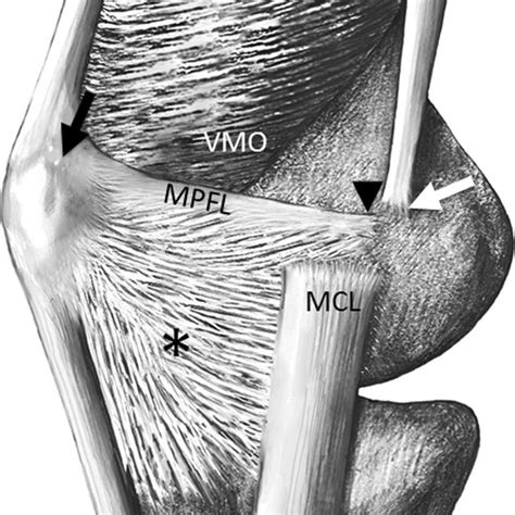 Wiberg Patellar Classification In A Type I Patella The Medial And