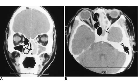 Sphenoid Sinus Invasion Of Olfactory Neuroblastoma In A 42 Year Old