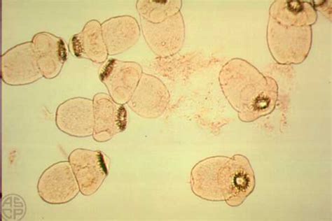Echinococcus Granulosus Hydatid Sand