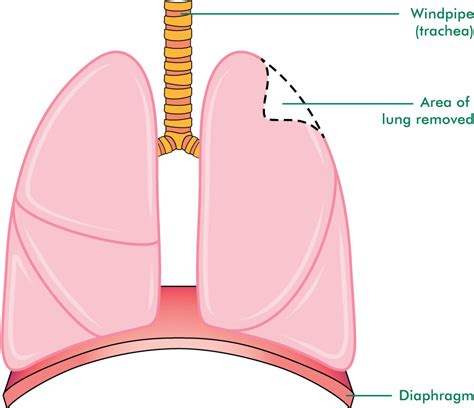 Surgery For Lung Cancer Information And Support Macmillan Cancer