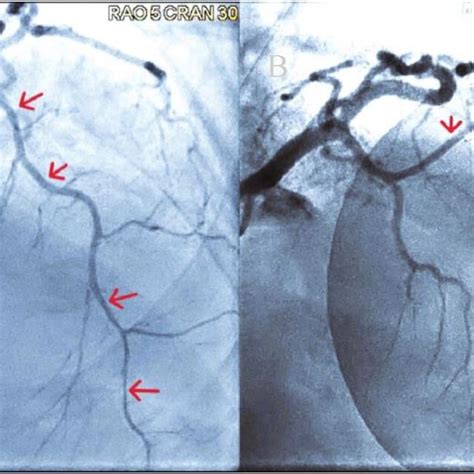Coronary Angiogram During Current Presentation Coronary Angiogram Download Scientific Diagram