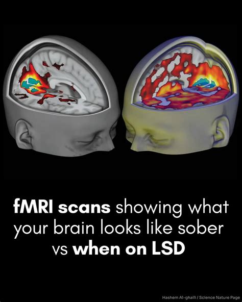 Hashem Scientists Scanned The Brain On Lsd — And What They Found