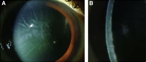 Advances In Endothelial Keratoplasty Surgery Advances In