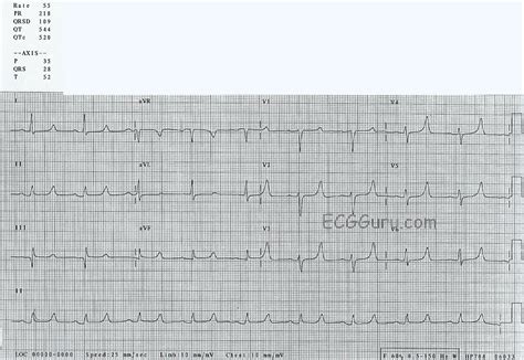 Peaked T Waves Ecg Guru Instructor Resources