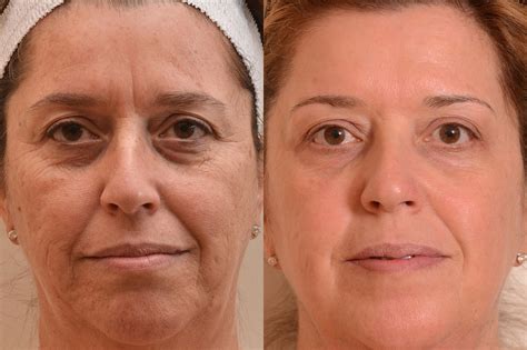 Laser Resurfacing An Infinitely Customizable Way To Improve Your Skin