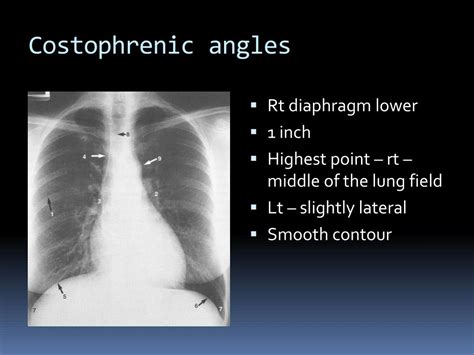 Ppt How To Read Xray Chest Powerpoint Presentation Free Download