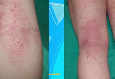 ¿cuál Es La Relación Entre Dermatitis Atópica Y Asma O Alergias