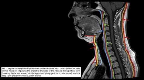 Imaging Of The Infrahyoid Neck Spacespdf Imaging Of The Infrahyoid Neck Spacespdf