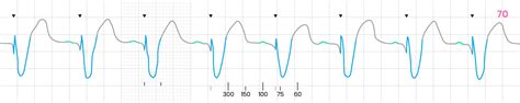 Atrial Sensed Ventricular Paced Rhythm Skillstat