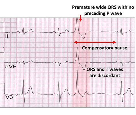 Ectopic Heartbeat Heart Rhythm Disorder Arrhythmia