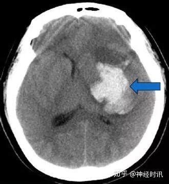 Ctmri