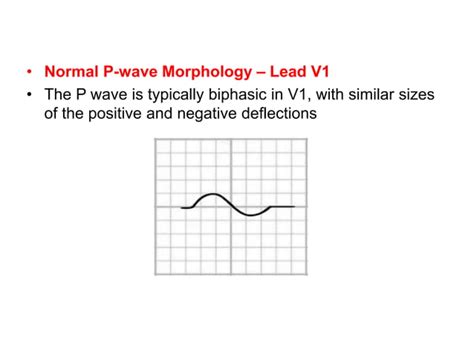 P Wave In Ecg Abnormalities Of P Wave In Ecg Pptx Heart And Cardiovascular Diseases
