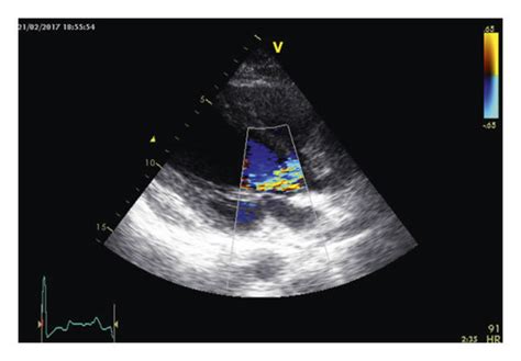 Doppler Echocardiography And Colour Flow Mapping Revealed Download Scientific Diagram