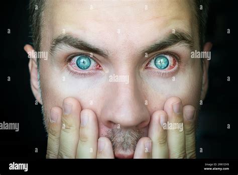 Redness Of The Mans Eyes A Surprised Look At The Camera