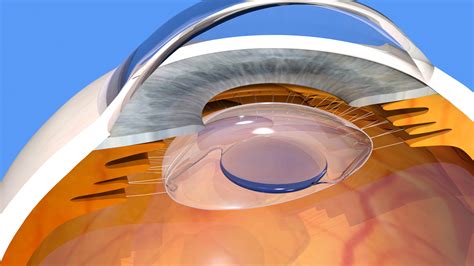 Multifocal Lens Intraocular Lenses Pros And Cons Prices And Success