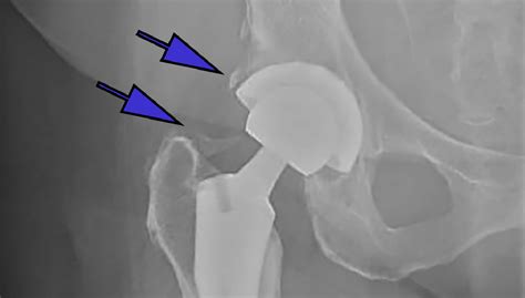 Figure 1 From Incidence Of Heterotopic Ossification In Direct Anterior