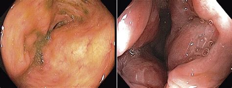 Rectal Gist Resection Following Neoadjuvant Therapyreporting Two Cases