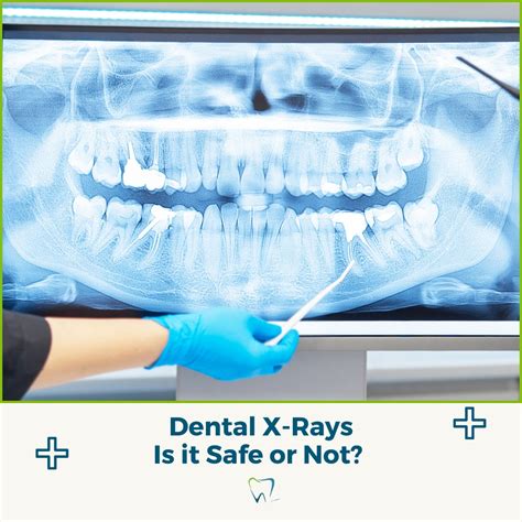 Calling Are Dental X Rays Dangerous Heres What You Need To Know