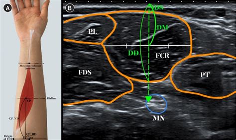 Figure 1 From Morphologic Evaluation Of The Flexor Carpi Radialis
