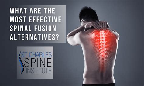 What Is Life Like After Spinal Fusion At Tara Brothers Blog