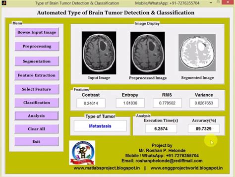 Types Of Brain Tumor Detection Using Matlab Project Code Ieee Based Project ~ Matlab Projects