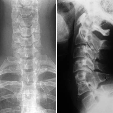Остеохондроз шейного отдела позвоночника признаки причины степени последствия диагностика и