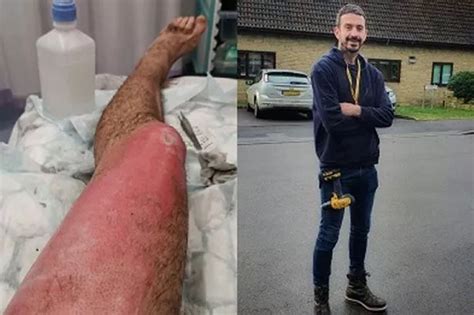 Man Left With Horrific Leg Burns Says Vape Explosion Felt Like Bomb