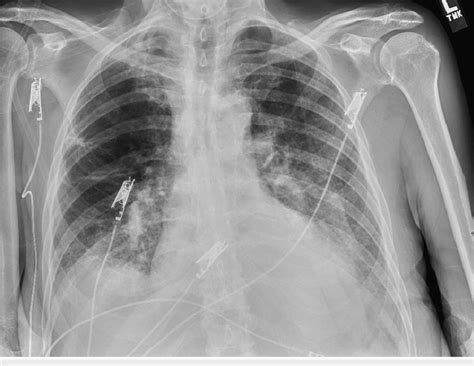 Chest X Ray Showing Interstitial Thickening With Ground Glass Density Download Scientific