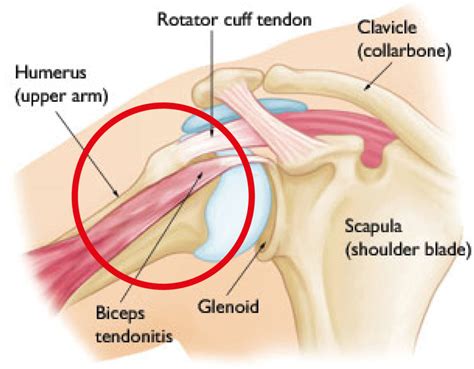 Biceps Tendonitis Causes Symptoms Diagnosis And Treatment How To Relief