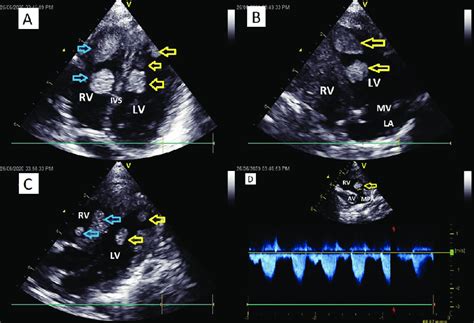 Echocardiography ECHO Images Of Case A A Modified Apical Download Scientific Diagram