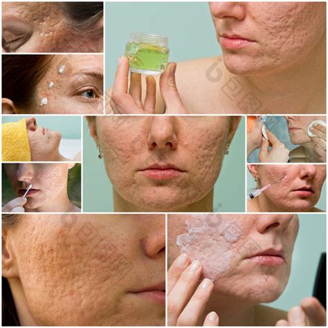 治疗痤疮疤痕图片 包图网企业站