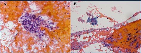 Cytomorphological Features Of Niftp With Microfollicular Pattern
