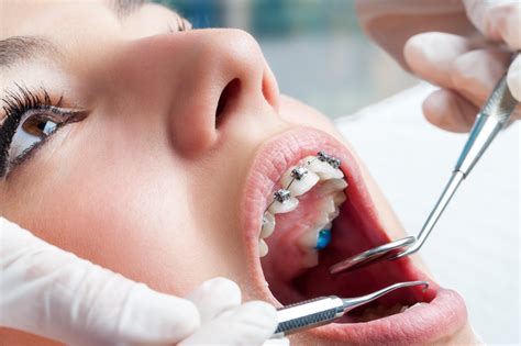 How Long Do Braces Hurt And How To Find Relief
